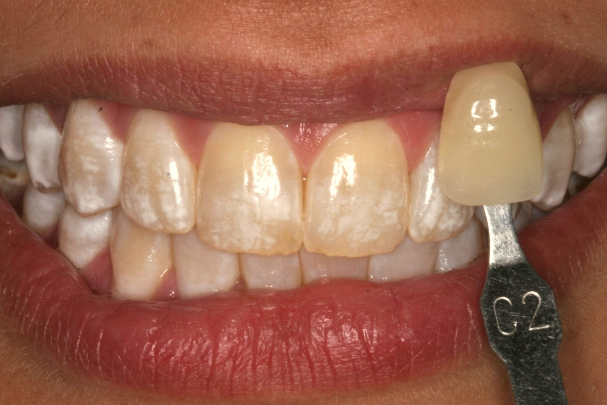 Get Professional Teeth Whitening For a Whiter Smile