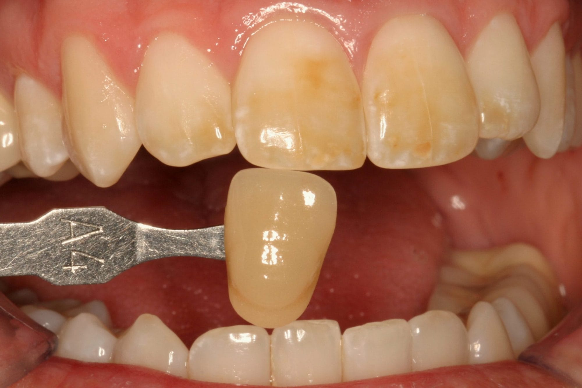 Get Professional Teeth Whitening For a Whiter Smile